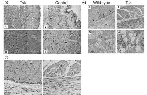 Fibrosis In Connective Tissue Disease The Role Of The Myofibroblast And Fibroblast Epithelial