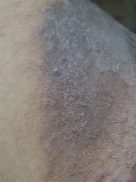 Help Ive Had This Rash For Months And It Dosent Seem To Be Going Away