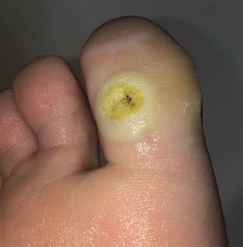 Plantar Wart Treatment Progression Rwarts