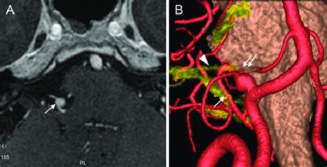 a axial fast spoiled gradient recalled echo sequence with gadolinium