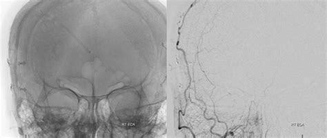 Direct Bypass Procedure Of Superficial Temporal Artery Sta And M My