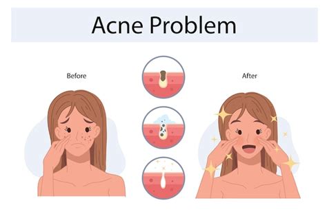 Premium Vector Upset Woman With Facial Skin Problem Infographic Of Acne Disease And Stages Of
