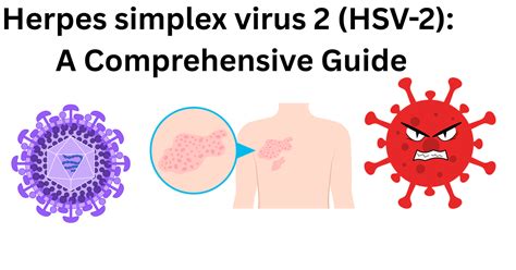 Herpes Simplex Virus 2 Hsv 2 A Comprehensive Guide