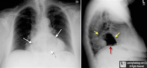 Learning Radiology Giant Hiatal Hernia