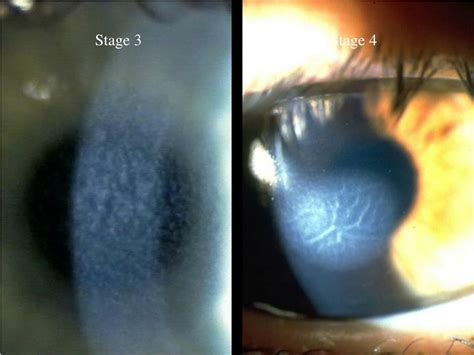 Ppt Diffuse Lamellar Keratitis Powerpoint Presentation Free Download
