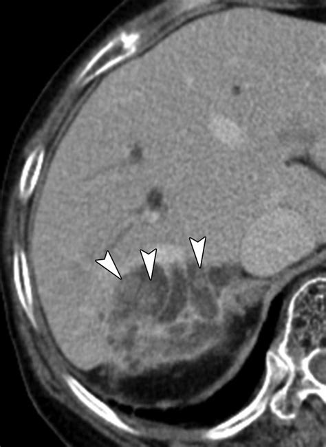 Cross Sectional Imaging Of Intrahepatic Cholangiocarcinoma Development