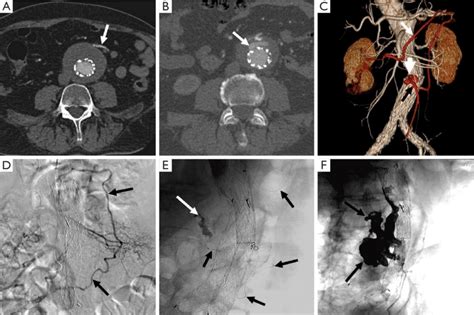 Treatment Of A Type Ii Endoleak Axial Contrast Enhanced Post Evar