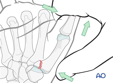 K Wire Fixation For Metacarpal Bennett Fracture