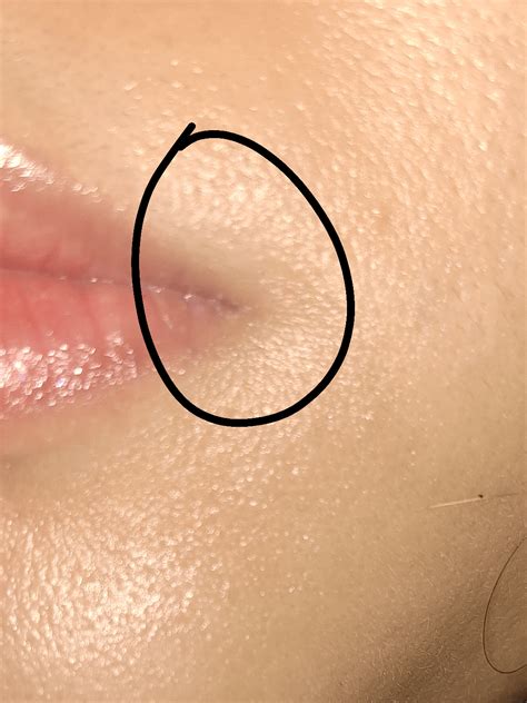 Pimple Cold Sore Angular Cheilitis R Diagnoseme