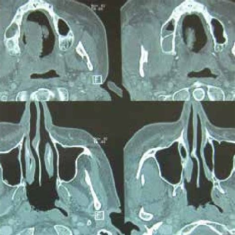 Significant Invasion Of The Recurrent Lesion To Infratemporal Space Download Scientific Diagram