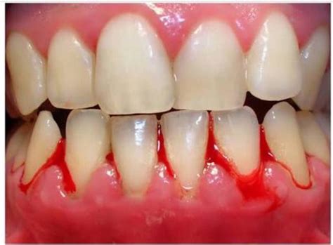 Persistent Bleeding Canyon Gate Dental Of Orem