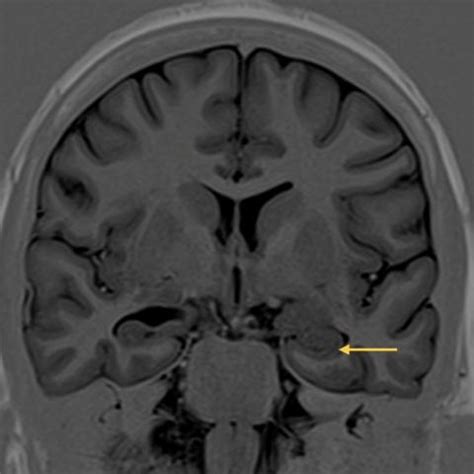 The Lazy Hippocampus A Case Of Incomplete Hippocampal Inversion Eurorad