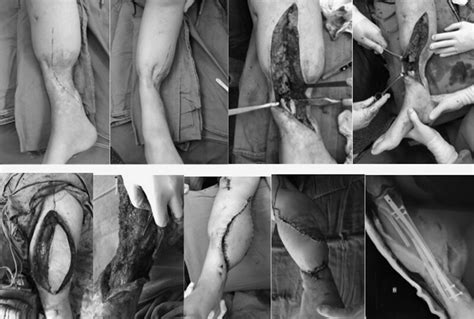 Female Years Old Chronic Traumatic Complex Defect Of Tibia Download Scientific Diagram