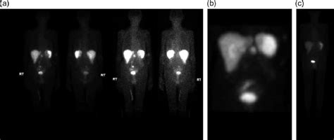 A C A And B Octreotide Scan Demonstrating Increased Activity In Download Scientific