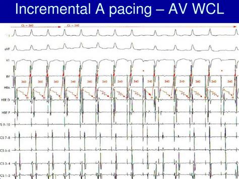Ppt Pr Inciples Of E P His Bundle Mapping Techniques Powerpoint Presentation Id4978187