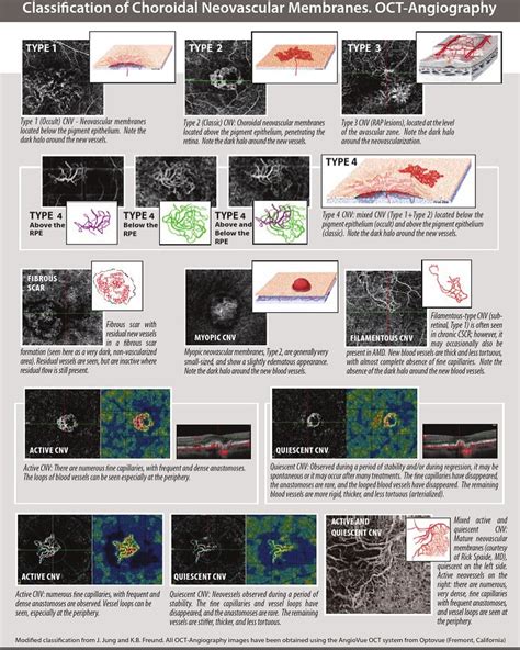 Piece Of Ophthalmology Added A Piece Of Ophthalmology
