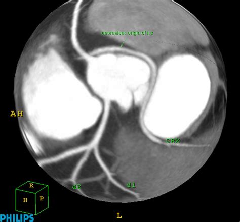 Coronary Anomaly Precision Scan