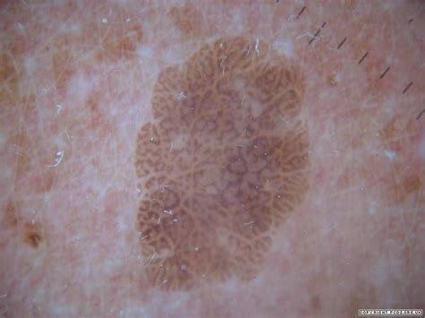Signos Dermatoscópicos Apariencia Cerebriforme Presencia De Múltiples
