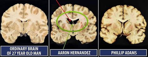 Comparison Of The Brain Of A Healthy 27 Year Old Vs Football Players