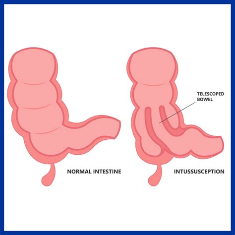 Small Intestine Disease Kaizen Hospital Small Bowel Disease
