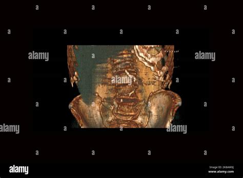 Computed Tomography Of The Spine With A Fracture Of The Vertebrae And