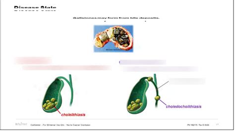 Cholecystectomy Disease State Diagram Quizlet