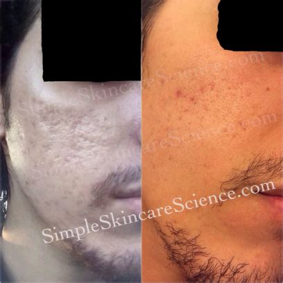 How To Pop A Pimple Using Science Avoid Scars Speed Recovery