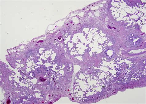 Diagnostic Criteria And Algorithm For Ipf Insights In Ild