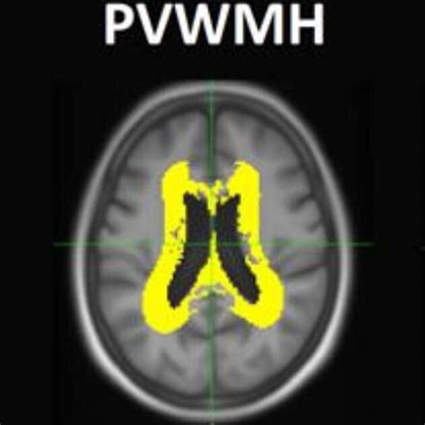 binary maps in yellow displaying from left to right wmh pvwmh and