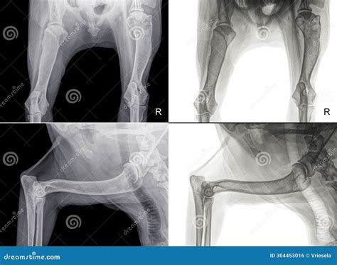 Osteosarcoma A Malignant Bone Tumor Light Micrograph Under The