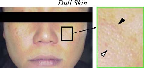 [pdf] Skin Translucency What Is It And How Is It Measured Semantic Scholar