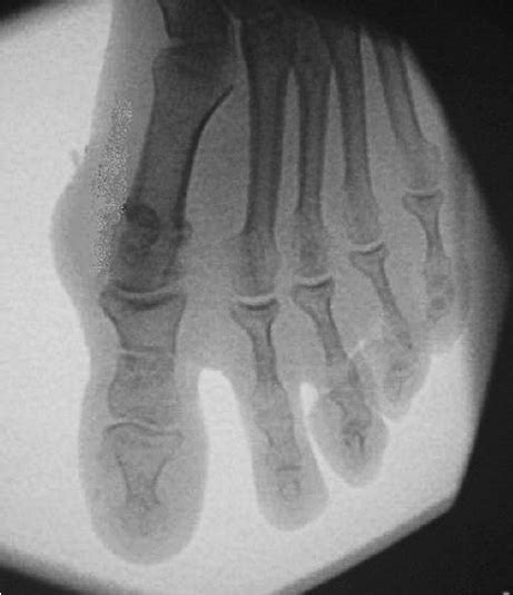 Percutaneous Akin First Phalanx Osteotomy Download Scientific Diagram