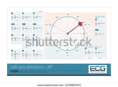 When Left Axis Deviation Maximum Qrs Stock Illustration 2230885963 Shutterstock