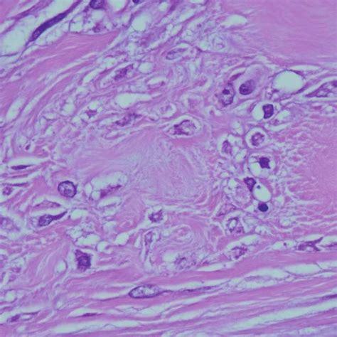 A Keloid Scar 40 X Showing Broad Glassy Collagen Download