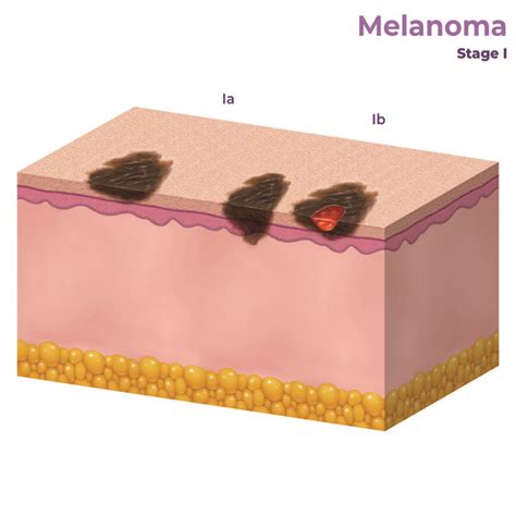 Melanoma Stage 1