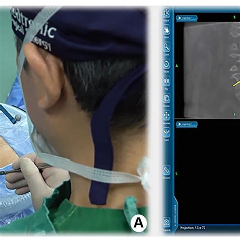 Extent Of Intraoperative Decompression Can Be Confirmed In Real Time On Download Scientific