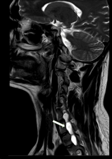 Mri Brachial Plexus T2 Right Parasagittal Section Of Case 1 Mri Download Scientific Diagram