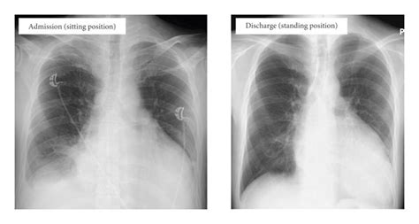 Imaging Findings At First Admission A Chest X Ray On Admission And Download Scientific