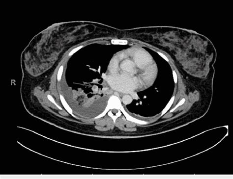 Transverse Ct Chest View Shows A Filling Defect In The Subsegmental Download Scientific Diagram