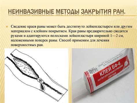 Кожный шов - презентация онлайн