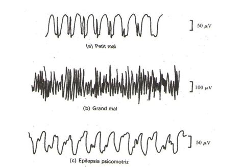 Different Types Of Epilepsy Download Scientific Diagram