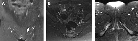 MR Imaging Evaluation Of Pediatric Genital Disorders Magnetic