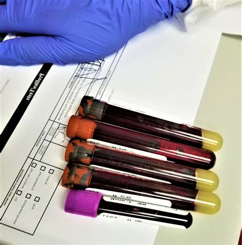 Acute Leukemia Nysora Nysora