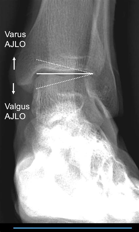 ankle joint line orientation ajlo was measured between a line