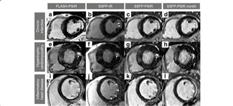 Representative Lge Images Three Selected Patients With Chronic Download Scientific Diagram