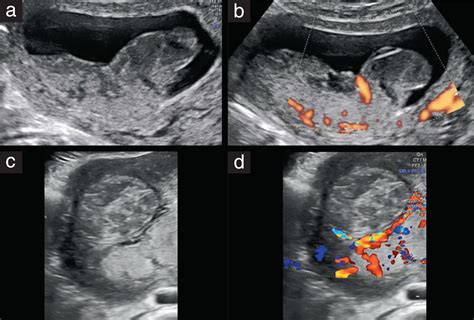 Abnormal Placenta Ultrasound Images
