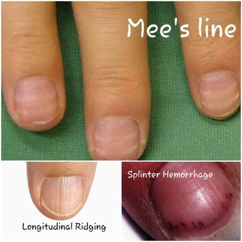 Nail Abnormality And Associated Systemic Disease Platform Cme