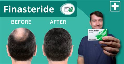 Video Guide Finasteride Hair Loss Tablets Pharmica