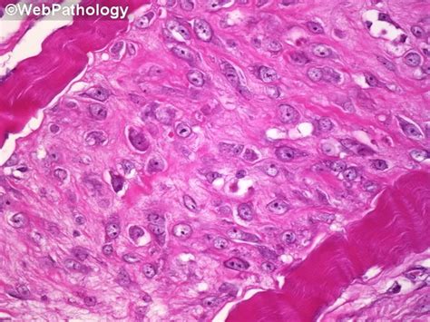 Proliferative Myositis Differential