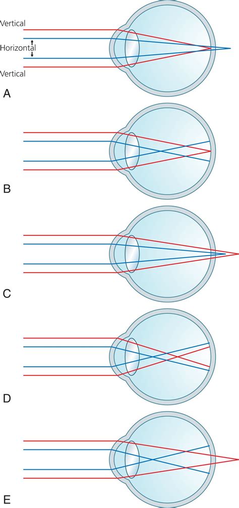 Refractive Errors And How To Correct Them Ento Key